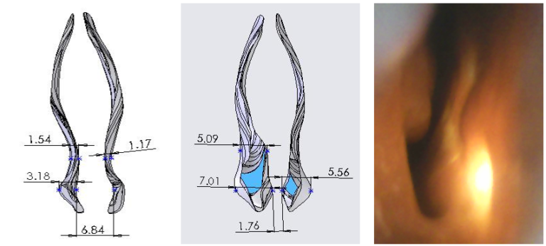 Centering the Septum and the importance of Symmetry Archives - Empty ...