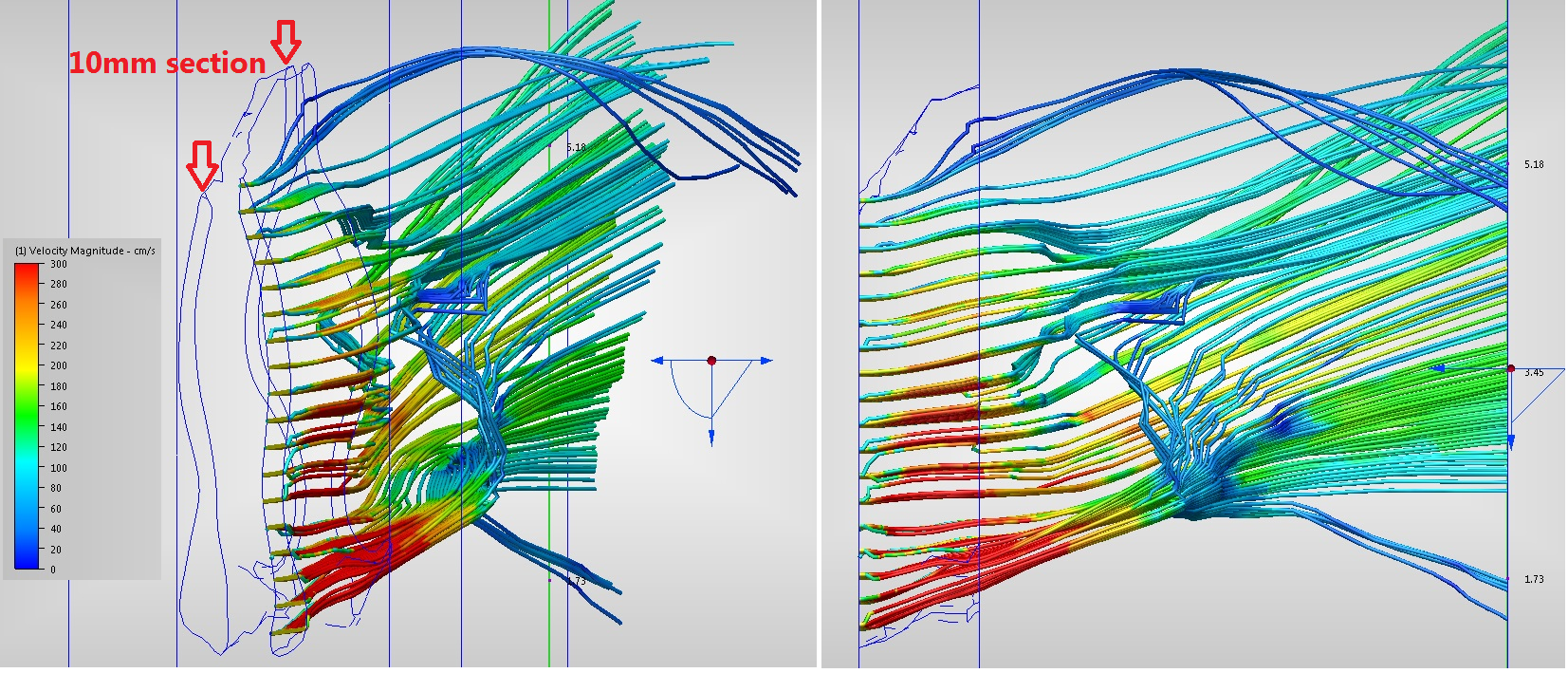 The Importance of the Nasal Valve and Inferior Turbinate heads - Empty ...