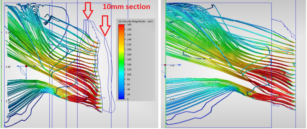 The Importance of the Nasal Valve and Inferior Turbinate heads - Empty ...