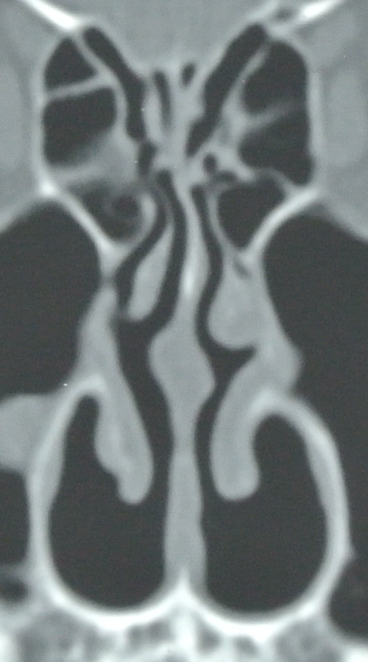 CT Scans for Models Archives - Page 2 of 3 - Empty Nose Syndrome ...