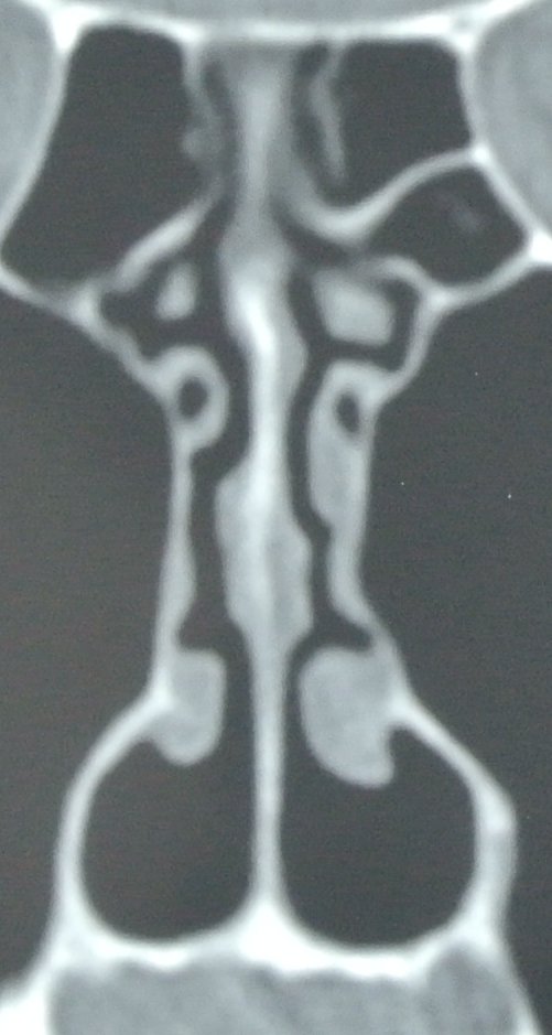 CT Scans for Models Archives - Page 2 of 3 - Empty Nose Syndrome ...
