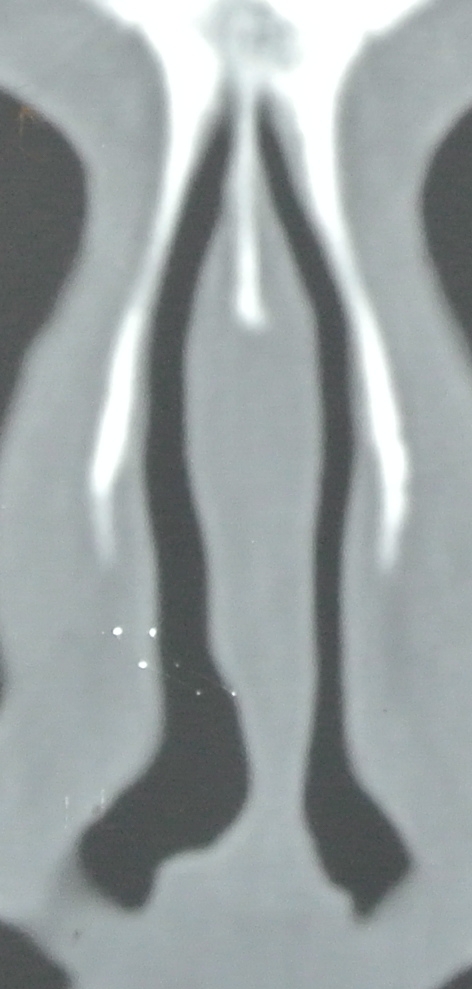 CT Scans for Models Archives - Page 2 of 3 - Empty Nose Syndrome ...