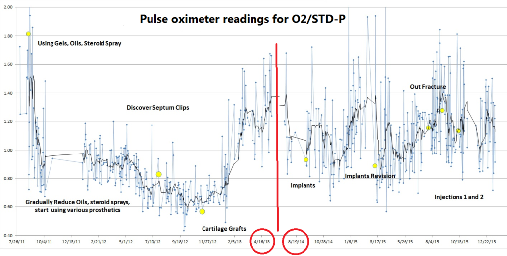 Sleep, Autonomic breathing and How Empty Nose Syndrome Destroys Sleep ...