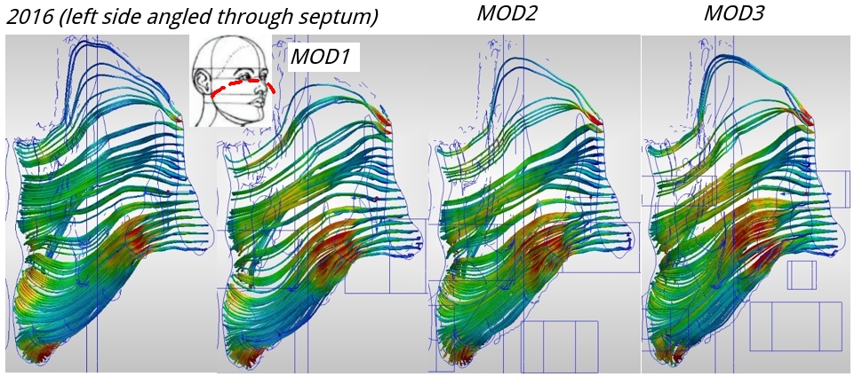 Surgical Repair of Empty Nose Syndrome - Empty Nose Syndrome Aerodynamics