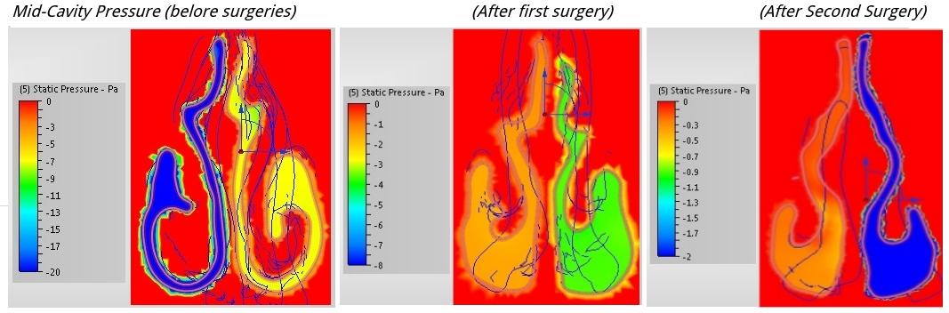 Surgical Repair of Empty Nose Syndrome - Empty Nose Syndrome Aerodynamics