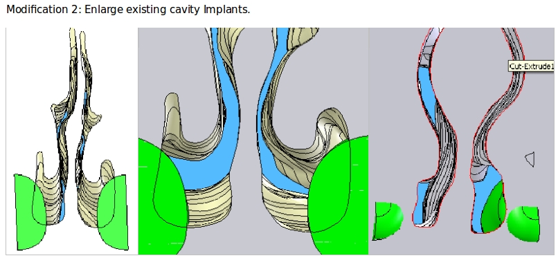 Surgical Repair of Empty Nose Syndrome - Empty Nose Syndrome Aerodynamics